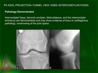 Intercondylar Fossa X Ray