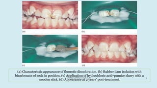 Advanced restorative dentistry | PPTX