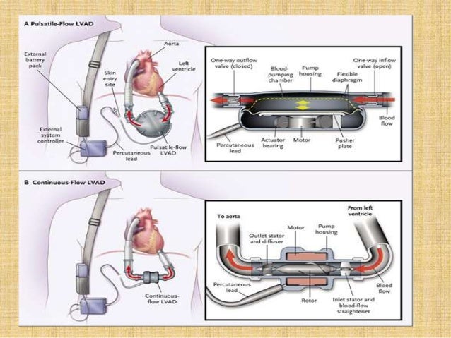Advanced treatment in hf ppt