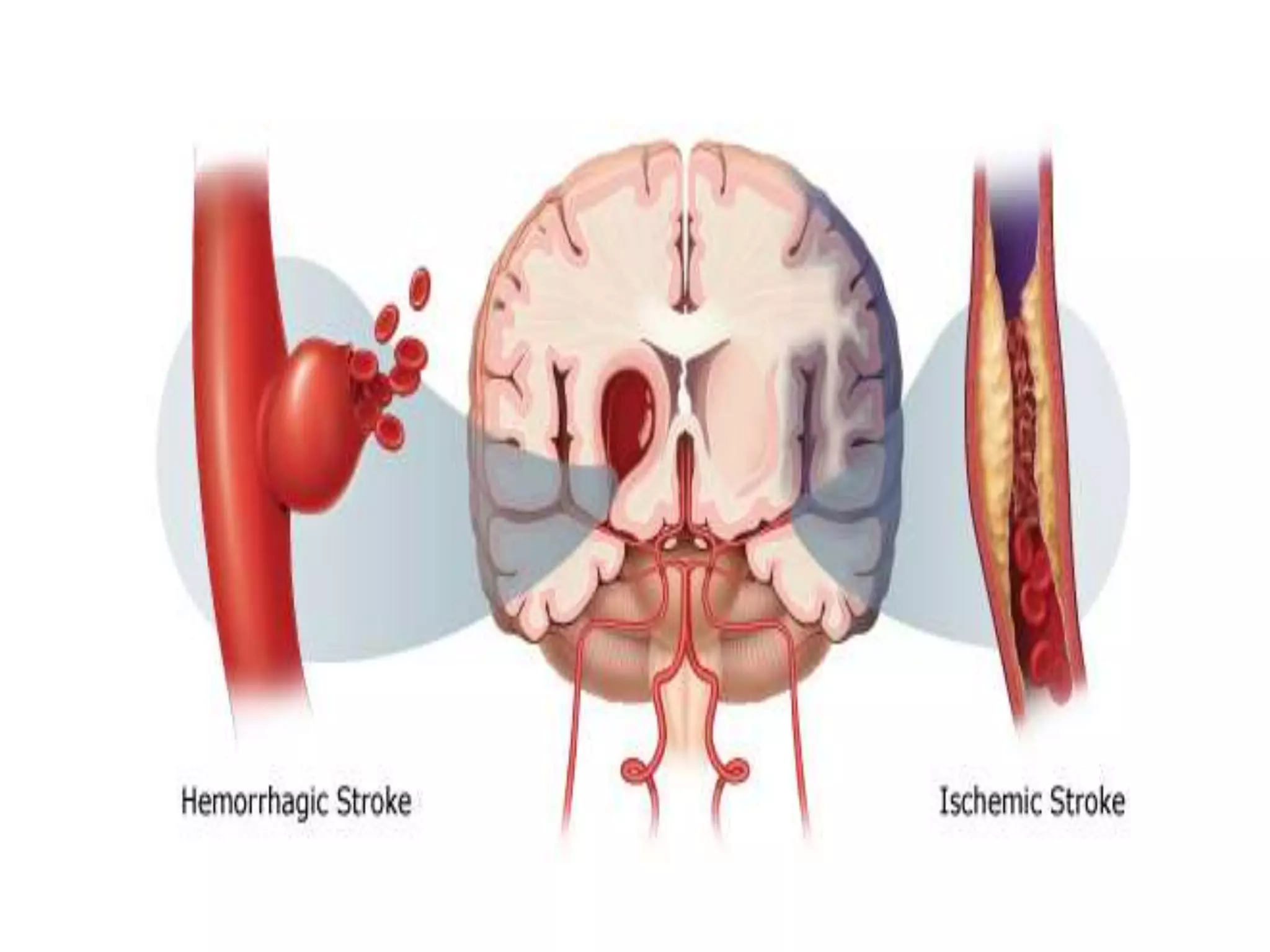 ADVANCED UPPER LIMB ORTHOTIC MANAGEMENT IN STROKE PPT.pptx