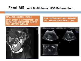Advanced usg lounge | PPTX