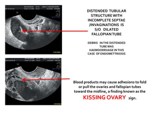 Advanced usg lounge gynaecology imaging series | PPTX | Pregnancy ...
