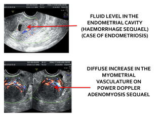 Advanced usg lounge gynaecology imaging series | PPTX