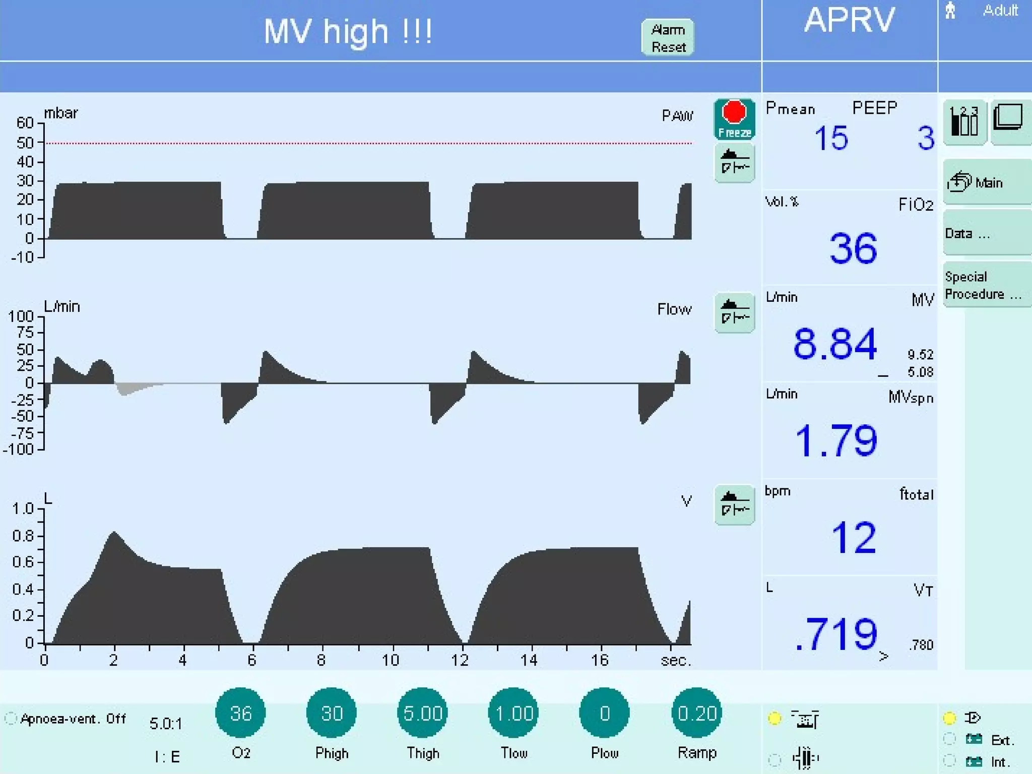 Advanced ventilatory modes | PPT