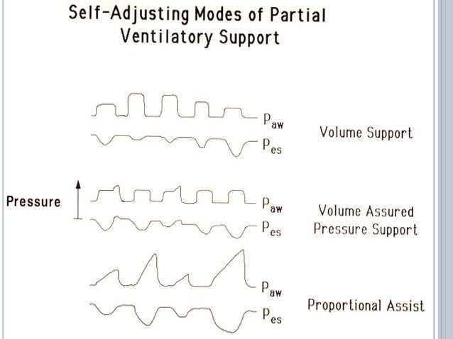 Advanced ventilatory modes | PPT