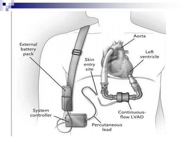 Advanced ventricular assist device ppt | PPTX | Heart and ...