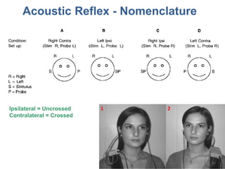 Advancement in acoustic reflex measures | PPT