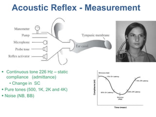 Advancement in acoustic reflex measures | PPT