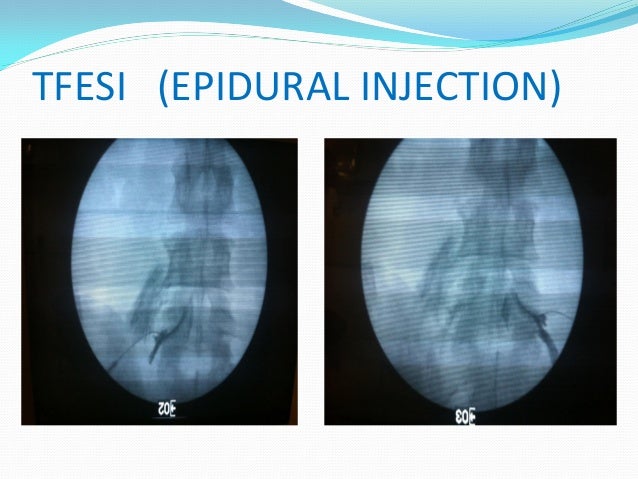 Advancement in back pain treatment