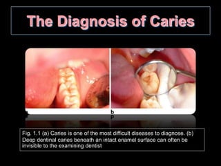 Advance method in detection of dental caries copy | PPT