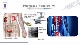 Preparing a patient for Intravenous Pyelogram. | PPTX