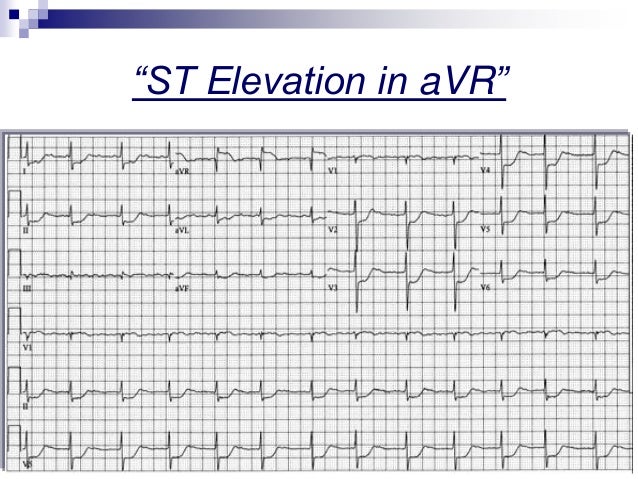 ECG in Emergency Department - Advances in ACS ECG