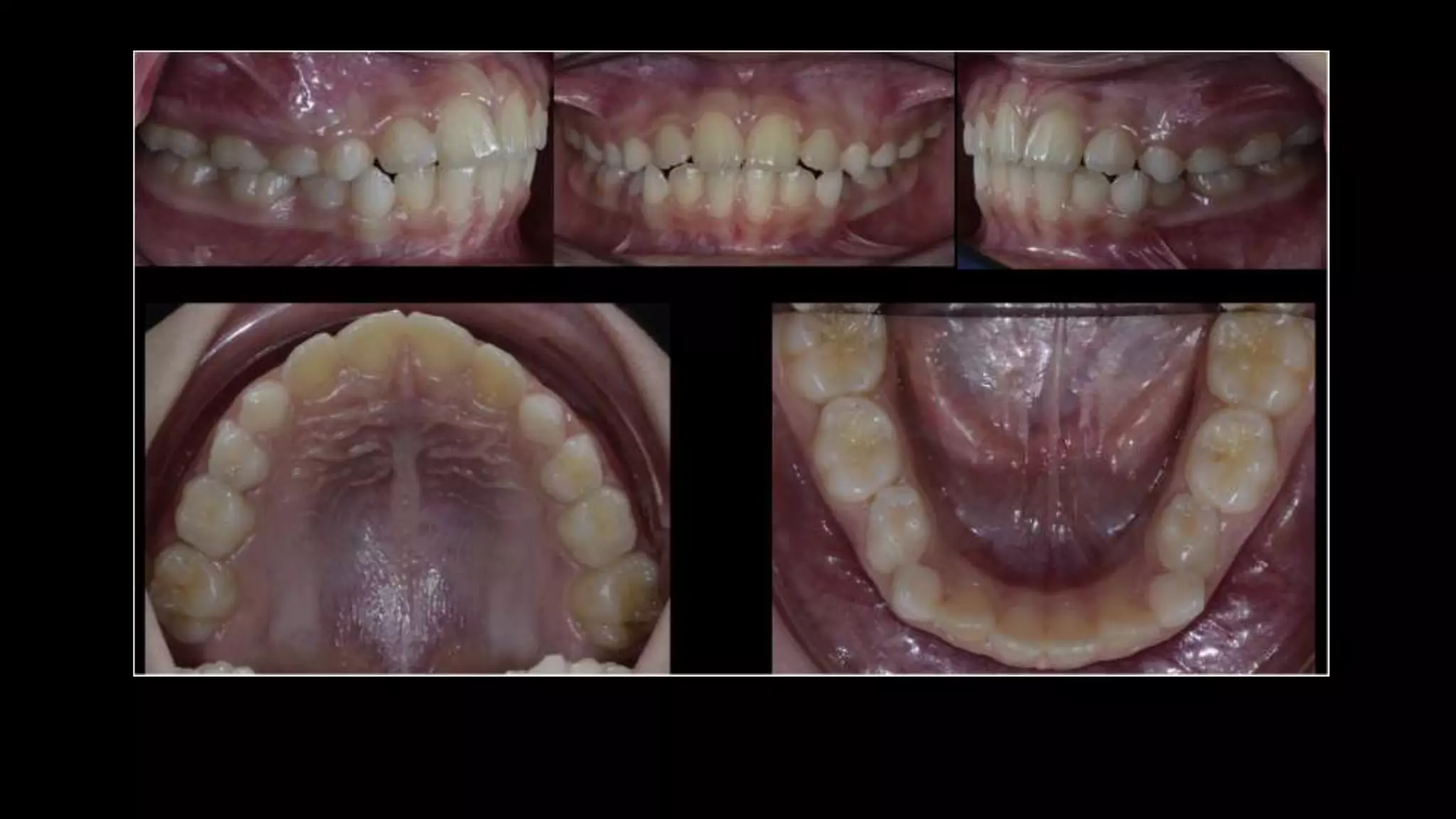 ADVANCES IN ALIGNER TREATMENT | PPTX