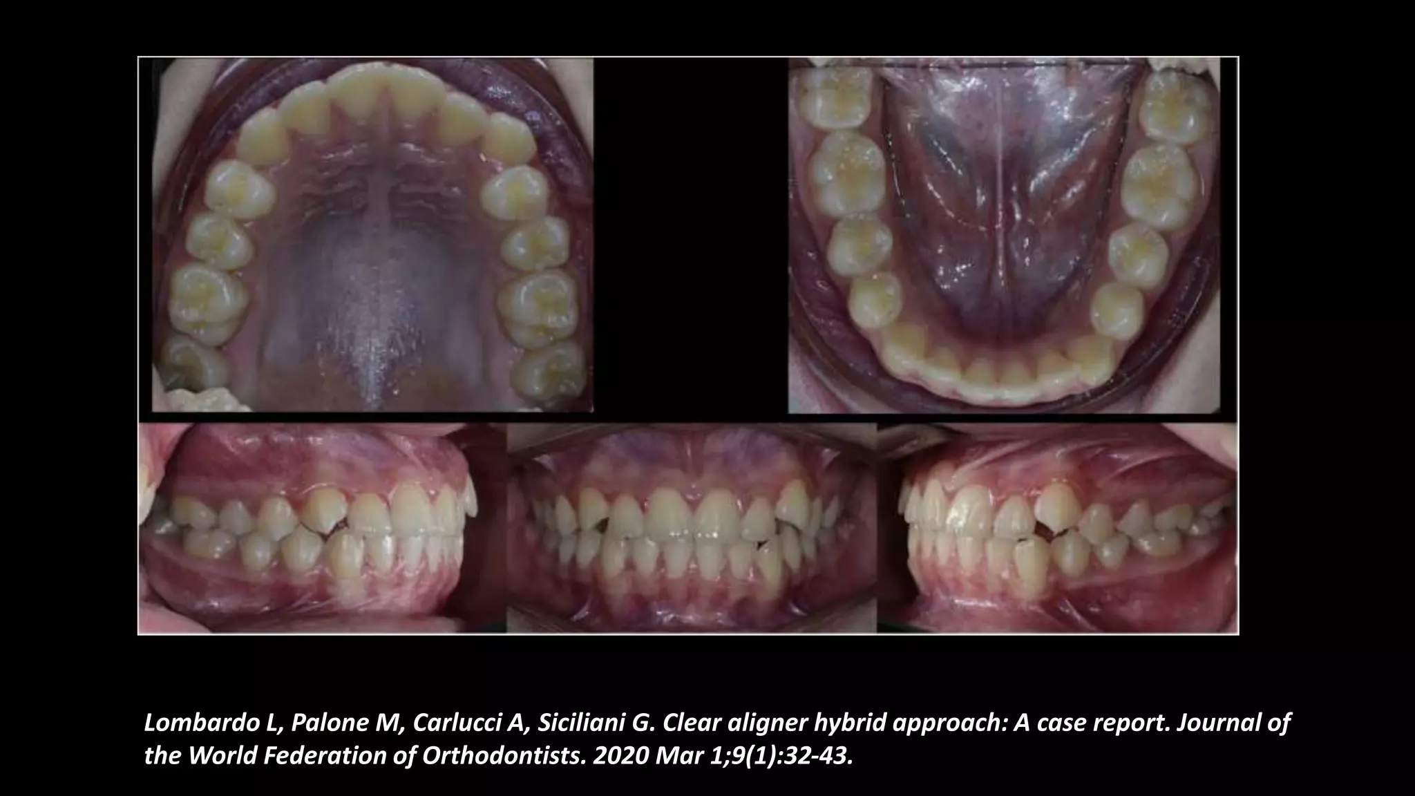 ADVANCES IN ALIGNER TREATMENT | PPTX