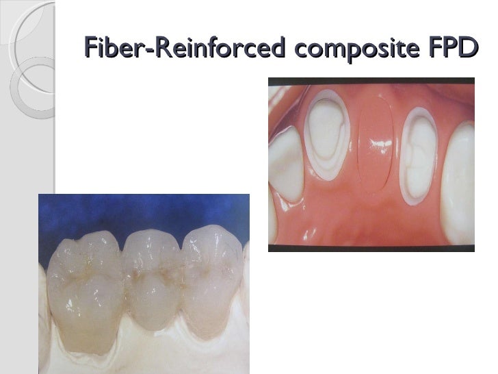 Advances in all ceramic restorations