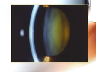 Advances in cataract surgery | PPT