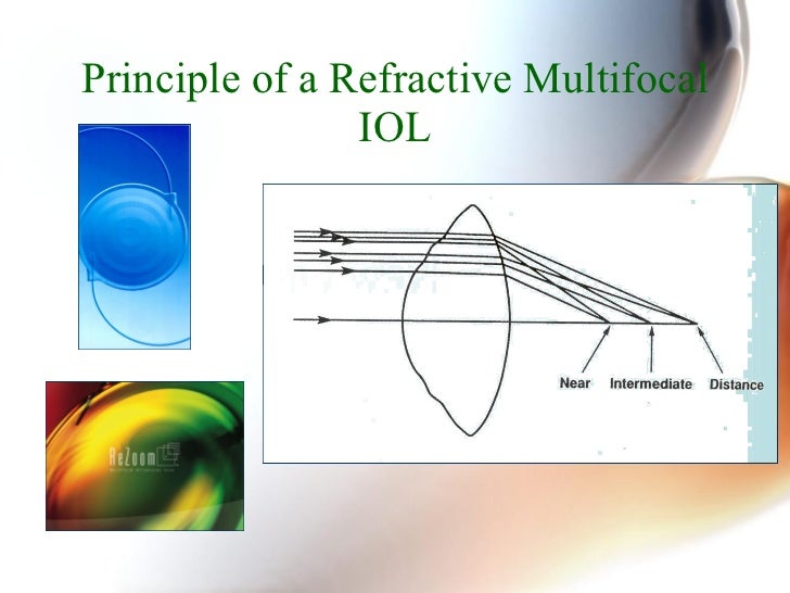 Advances in cataract surgery