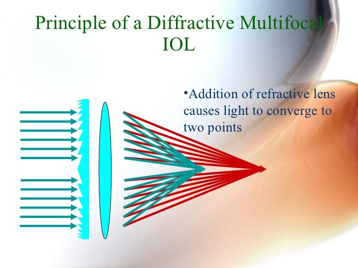 Advances in cataract surgery