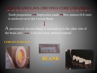 Recent Advances in Dental Ceramics | PPTX