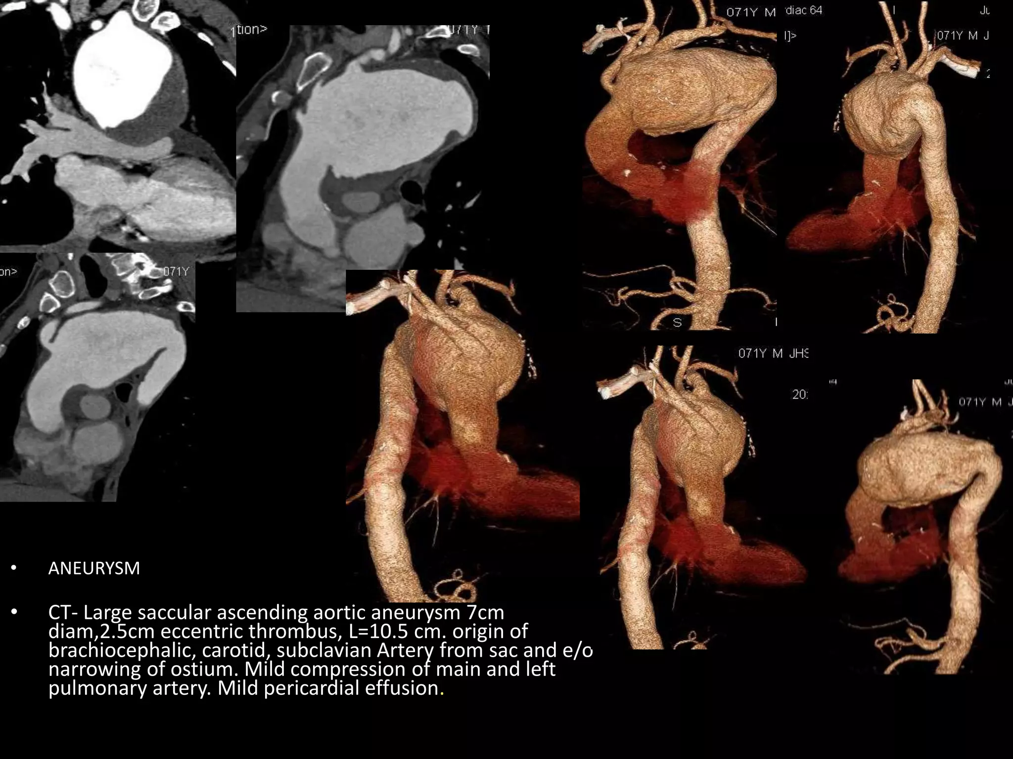 Advances in ct technology | PPTX