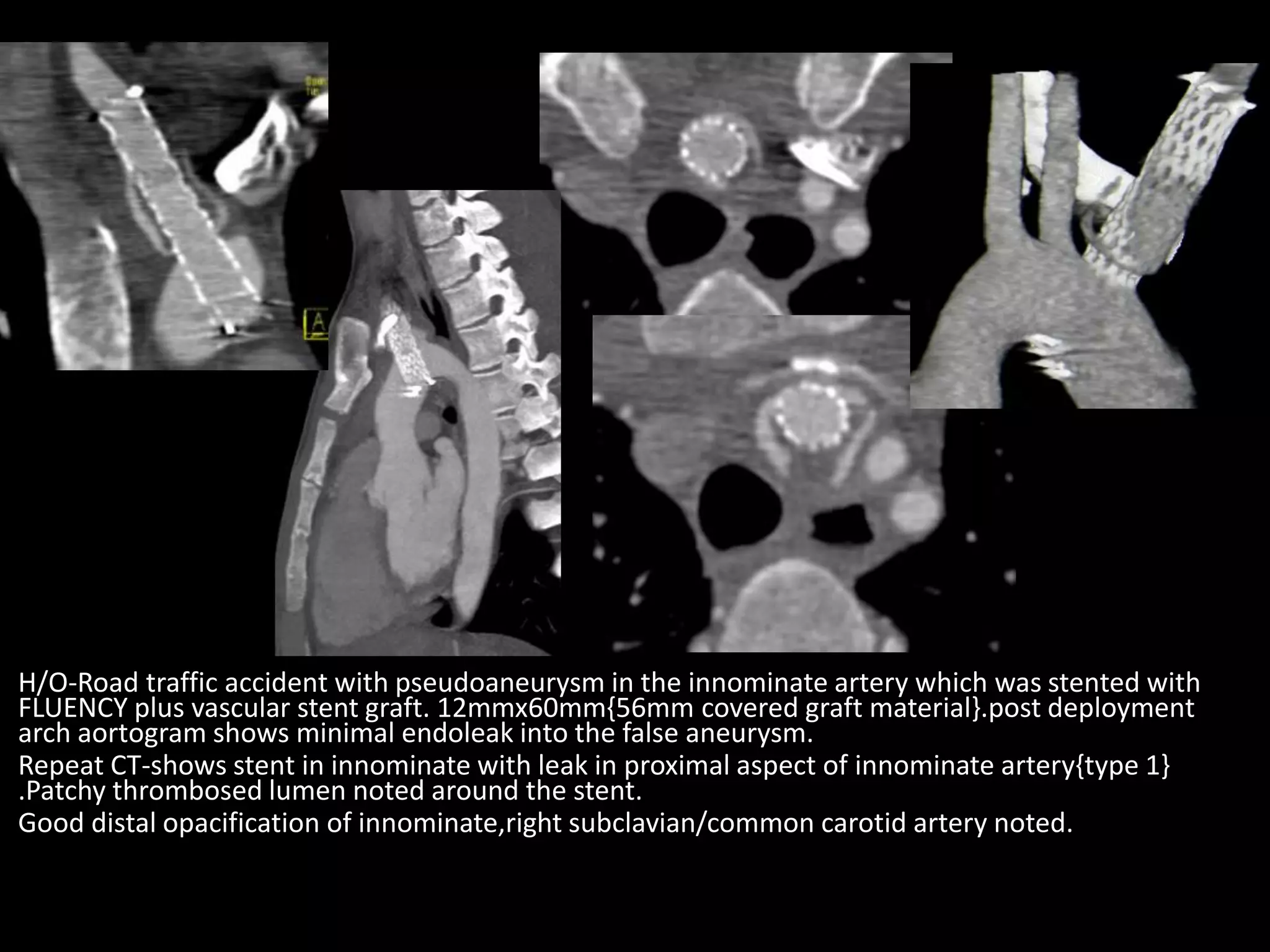 Advances in ct technology | PPTX