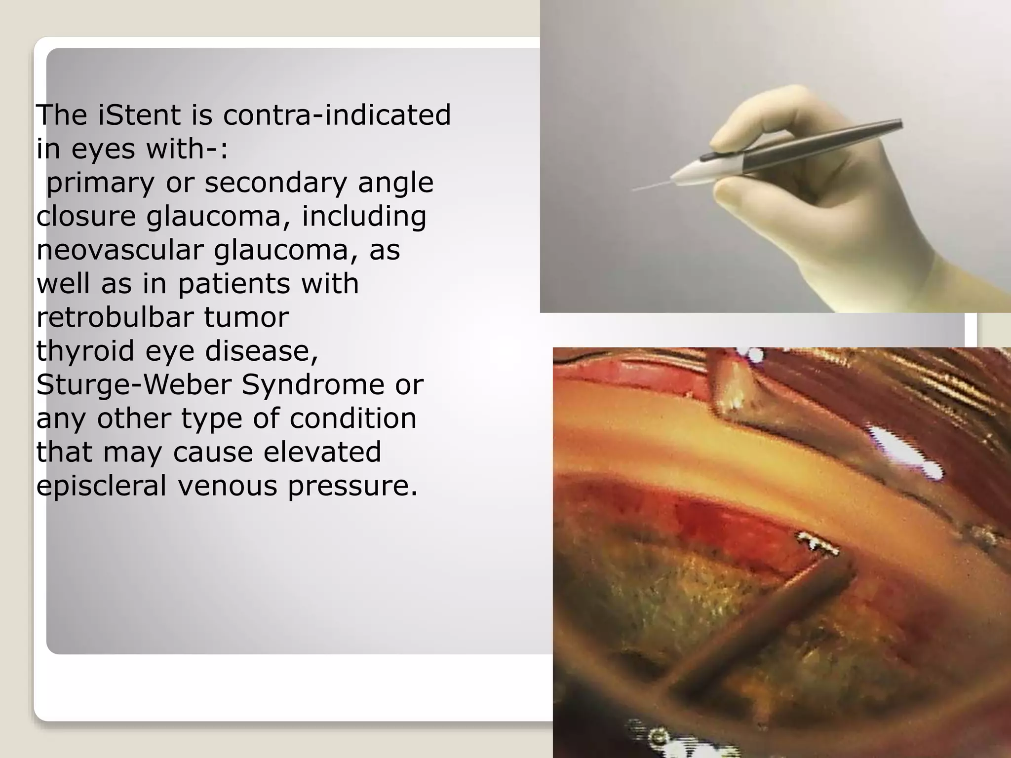Advances in glaucoma surgeries | PPTX