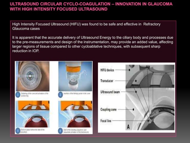 Advances in glaucoma surgeries | PPTX