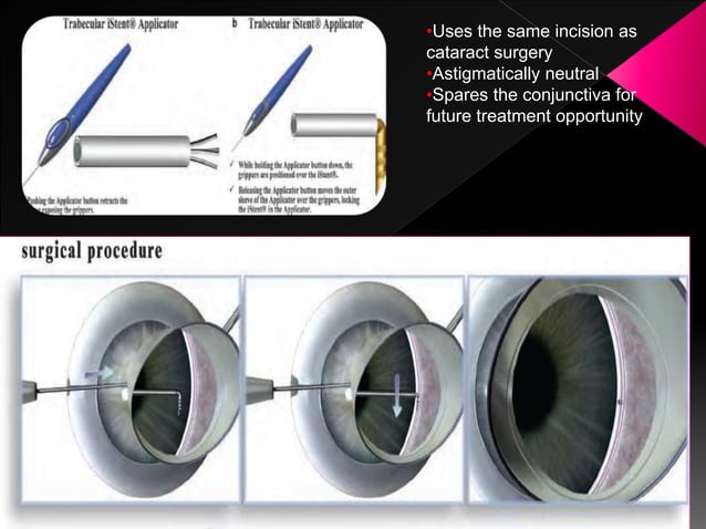 Advances in glaucoma surgeries | PPTX