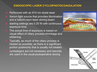 Advances in glaucoma surgeries | PPT
