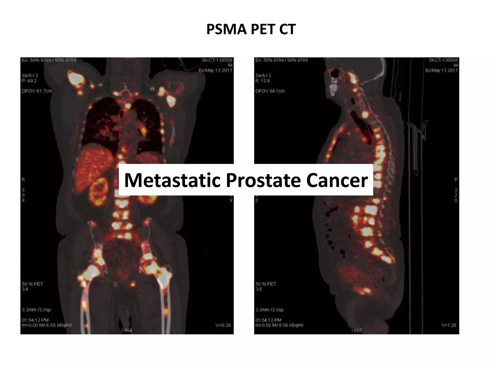 Advances in management of hormone sensitive prostate cancer | PPTX