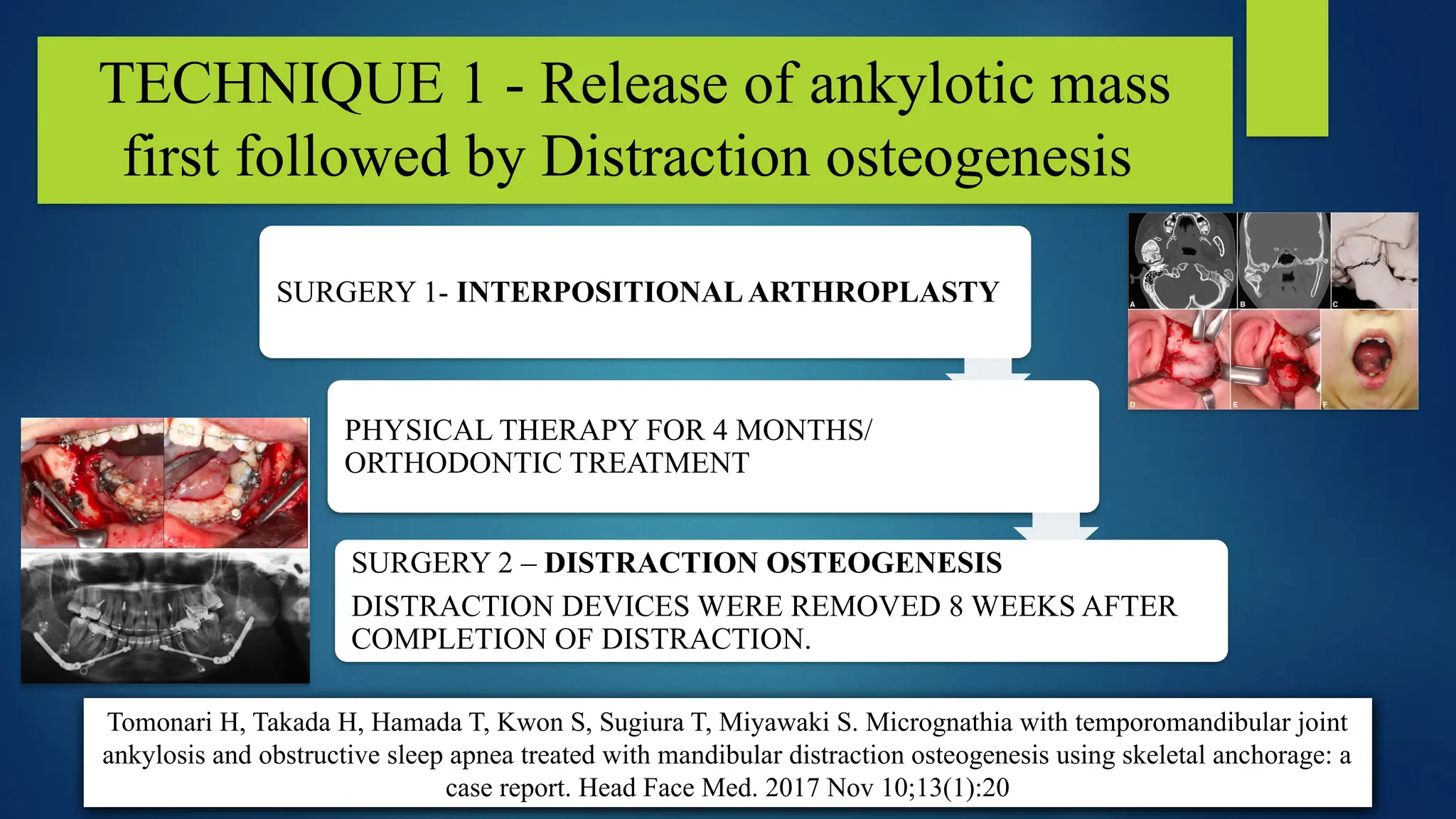 Advances in the Management of Temporomandibular Joint Ankylosis.pptx