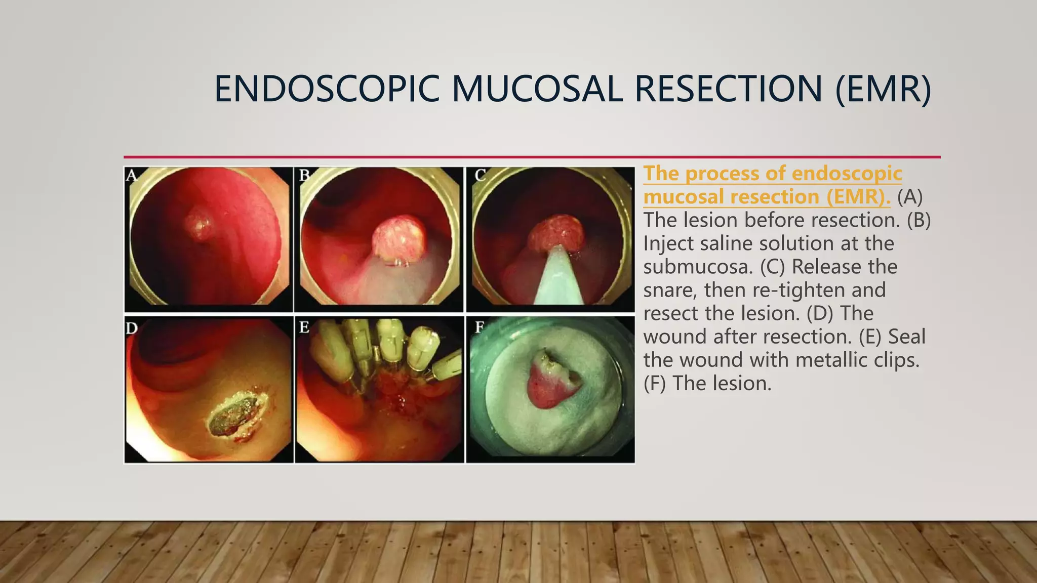 ADVANCES IN THIRD SPACE ENDOSCOPY upload.pptx