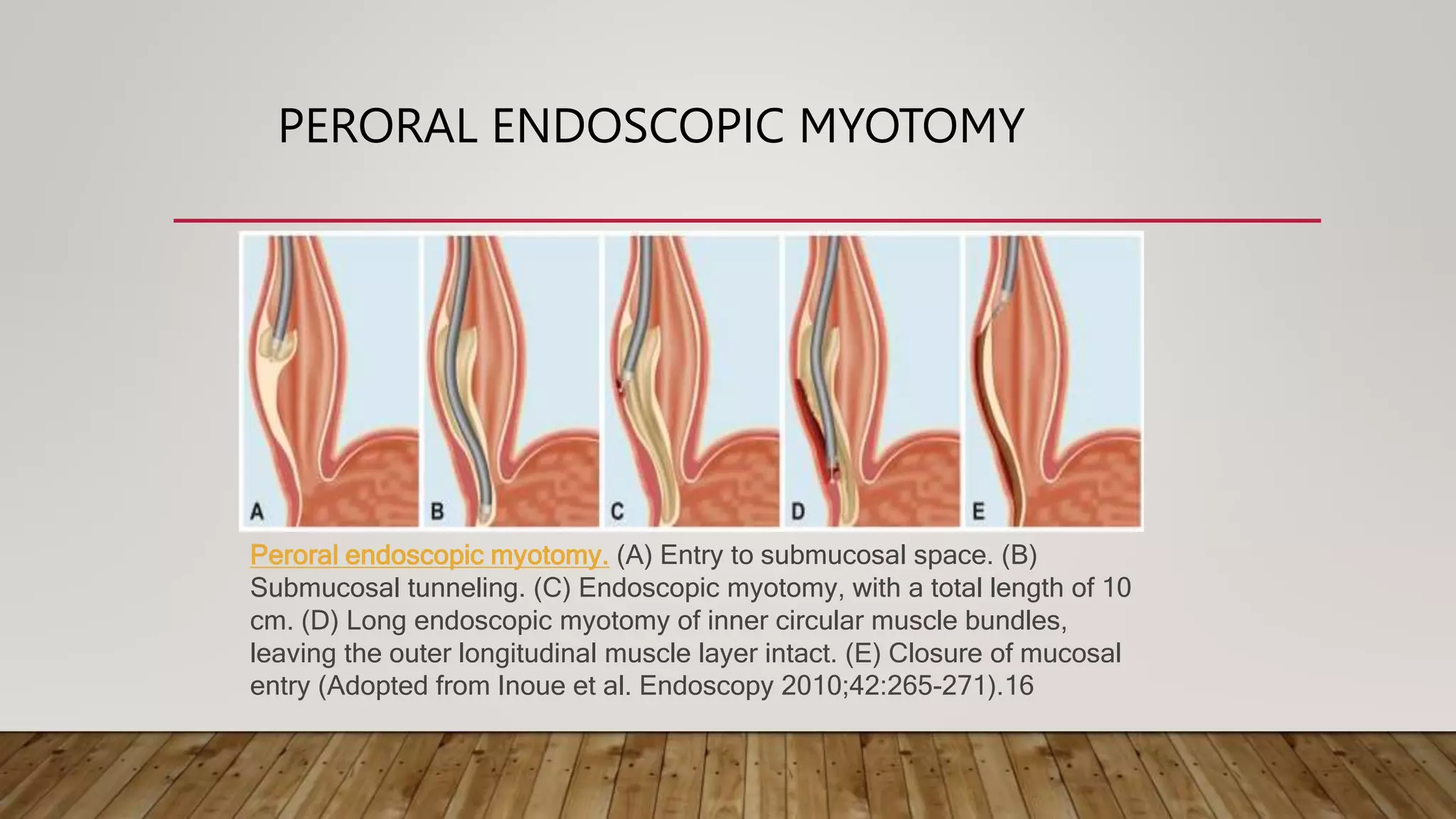 ADVANCES IN THIRD SPACE ENDOSCOPY upload.pptx