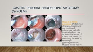 ADVANCES IN THIRD SPACE ENDOSCOPY upload.pptx