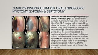 ADVANCES IN THIRD SPACE ENDOSCOPY upload.pptx