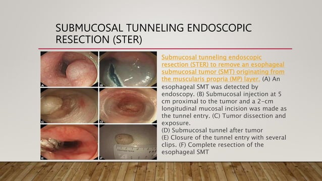 ADVANCES IN THIRD SPACE ENDOSCOPY upload.pptx