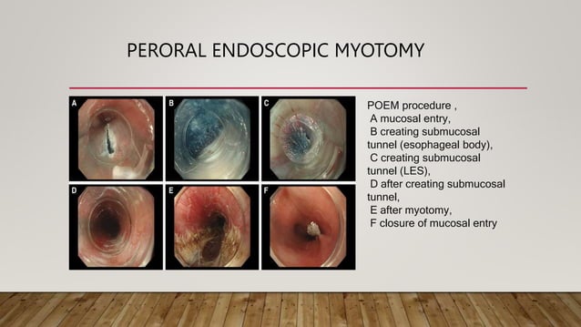 Advances In Third Space Endoscopy Uploadpptx 