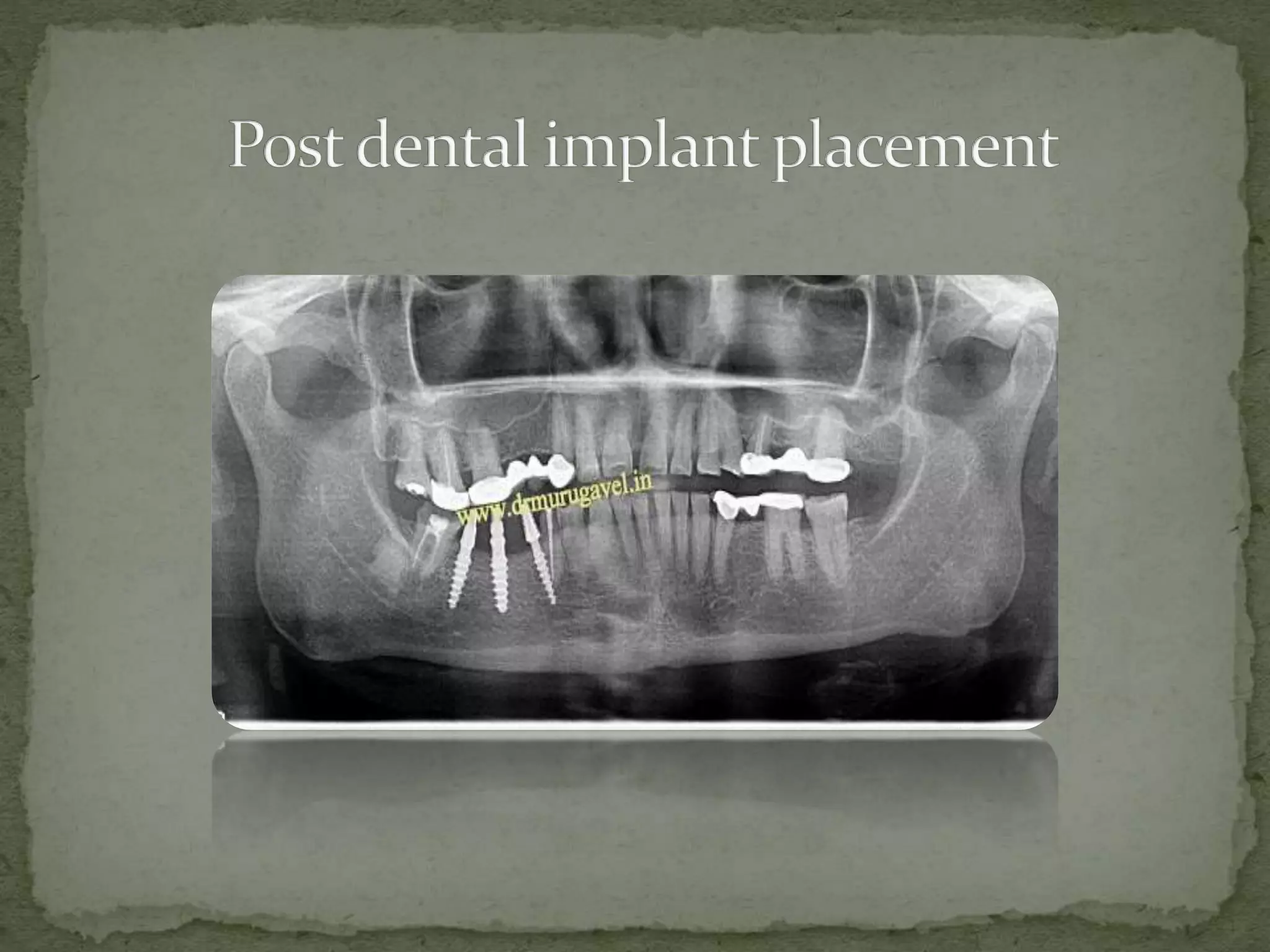 Advantages of basal compressive implants | PPTX