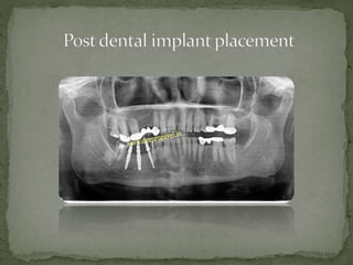 Advantages of basal compressive implants | PPTX