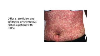Adverse cutaneous drug reactions | PPTX
