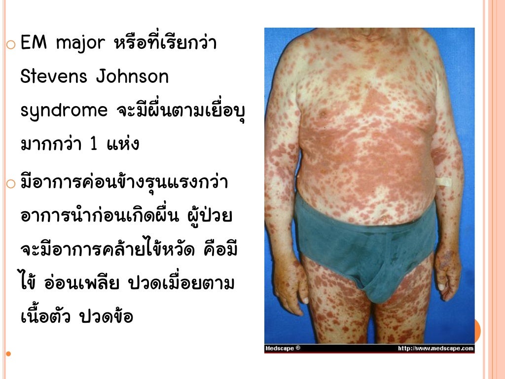 Adverse Drug Reaction 09 adverse-drug-reaction-09