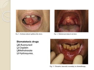 Adverse drug reactions of oral cavity | PPTX