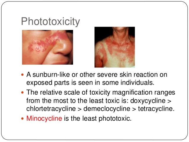 Adverse drug reactions of tetracycline antibiotics
