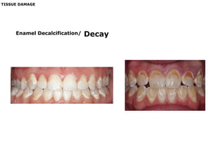 Adverse Effects of Orthodontic Treatment | PDF