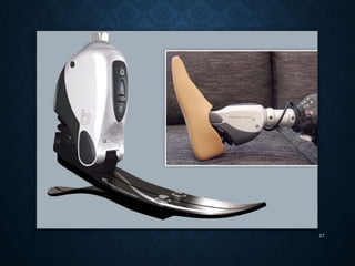 Recent Advances In Lower Limb Prosthesis | PPT