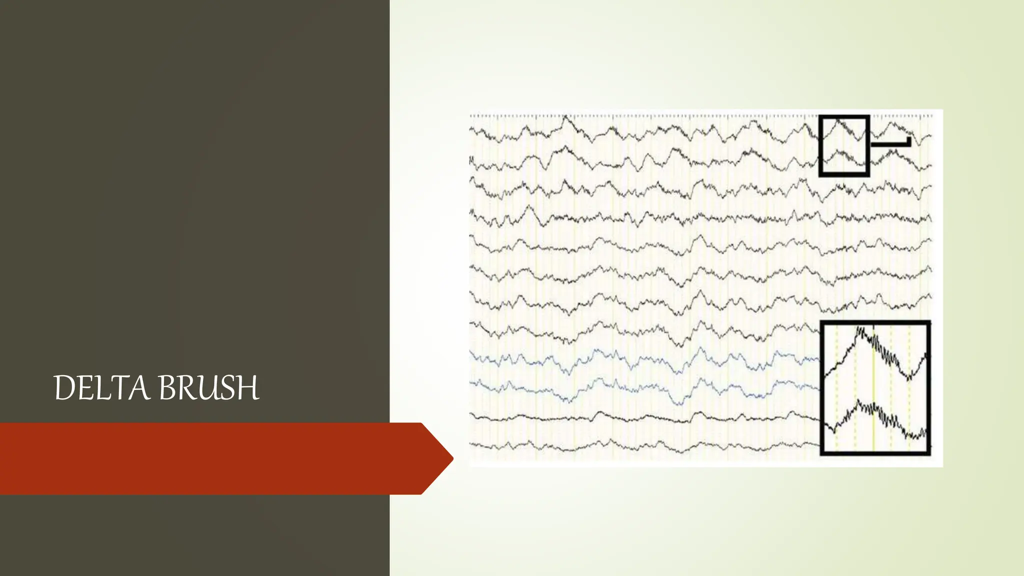 Autoimmune encephalitis in children, when to suspect. | PPTX