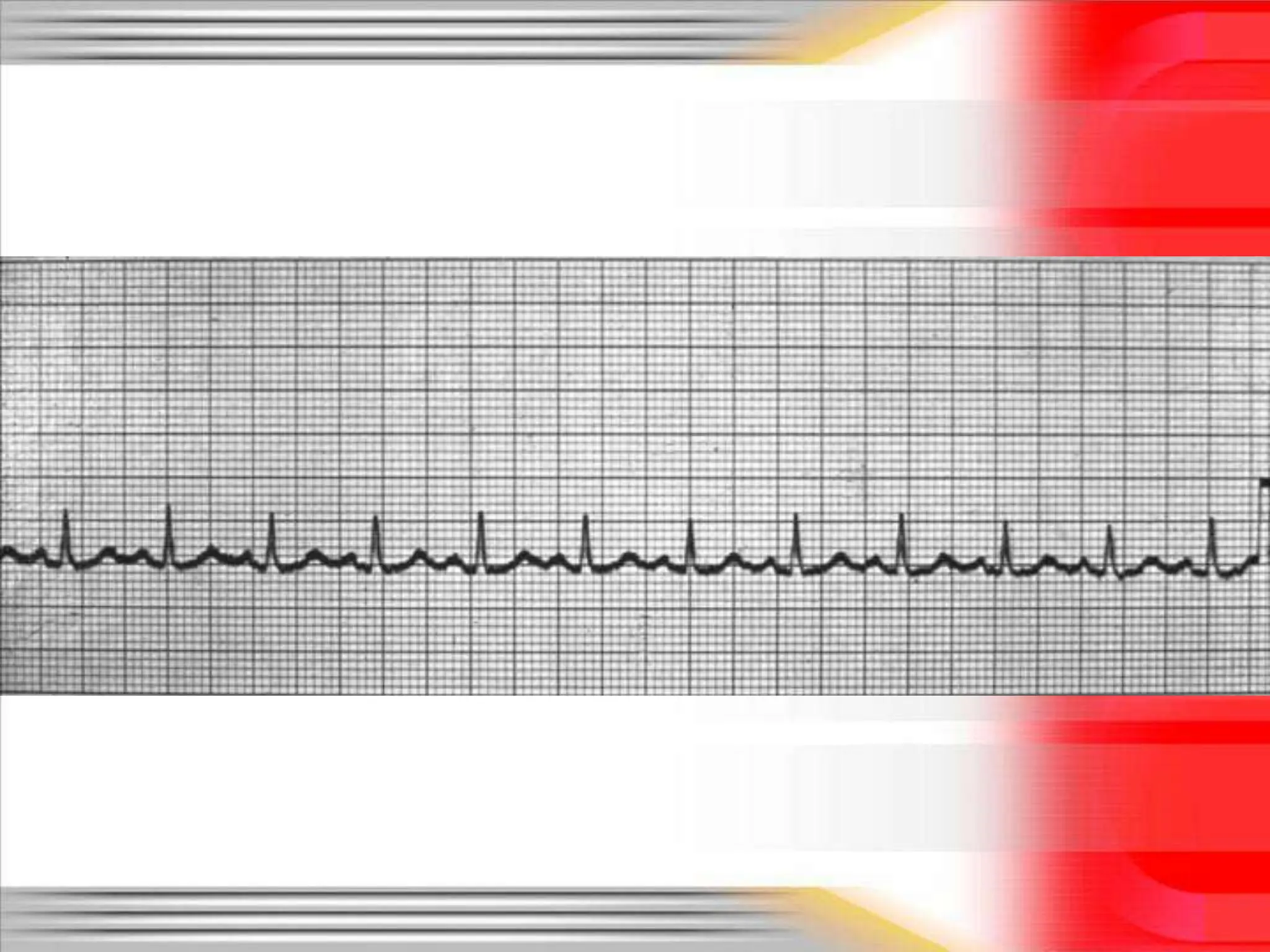 AED & Basic ECG - Full Basic Life Support 2016 | PPT