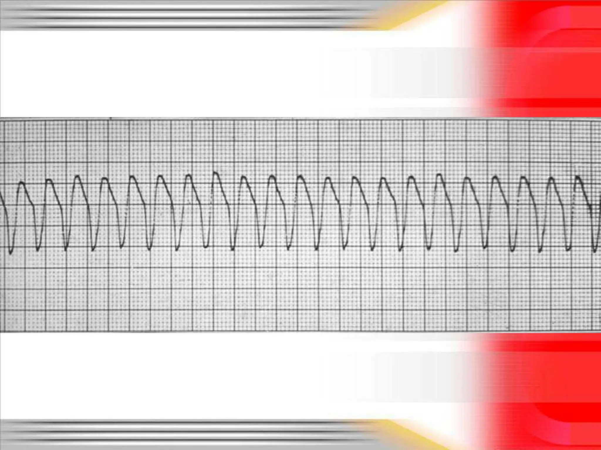 AED & Basic ECG - Full Basic Life Support 2016 | PPT