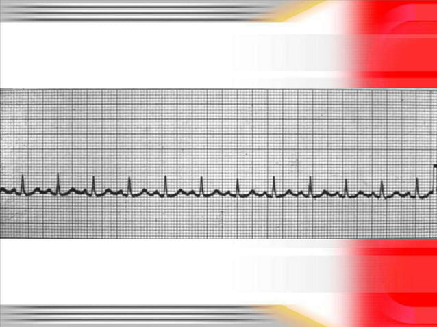AED & Basic ECG - Full Basic Life Support 2016 | PPT