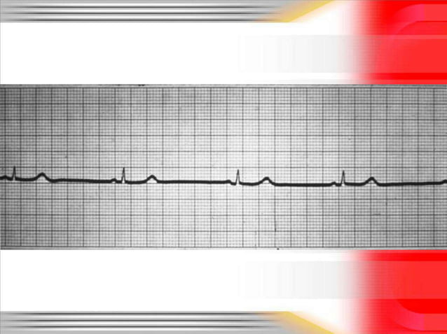 AED & Basic ECG - Full Basic Life Support 2016 | PPT